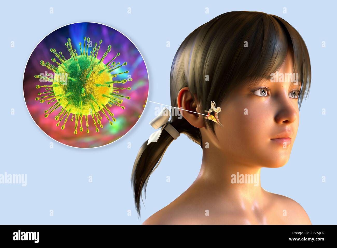Viral otitis media, a group of inflammatory diseases of the middle ear ...