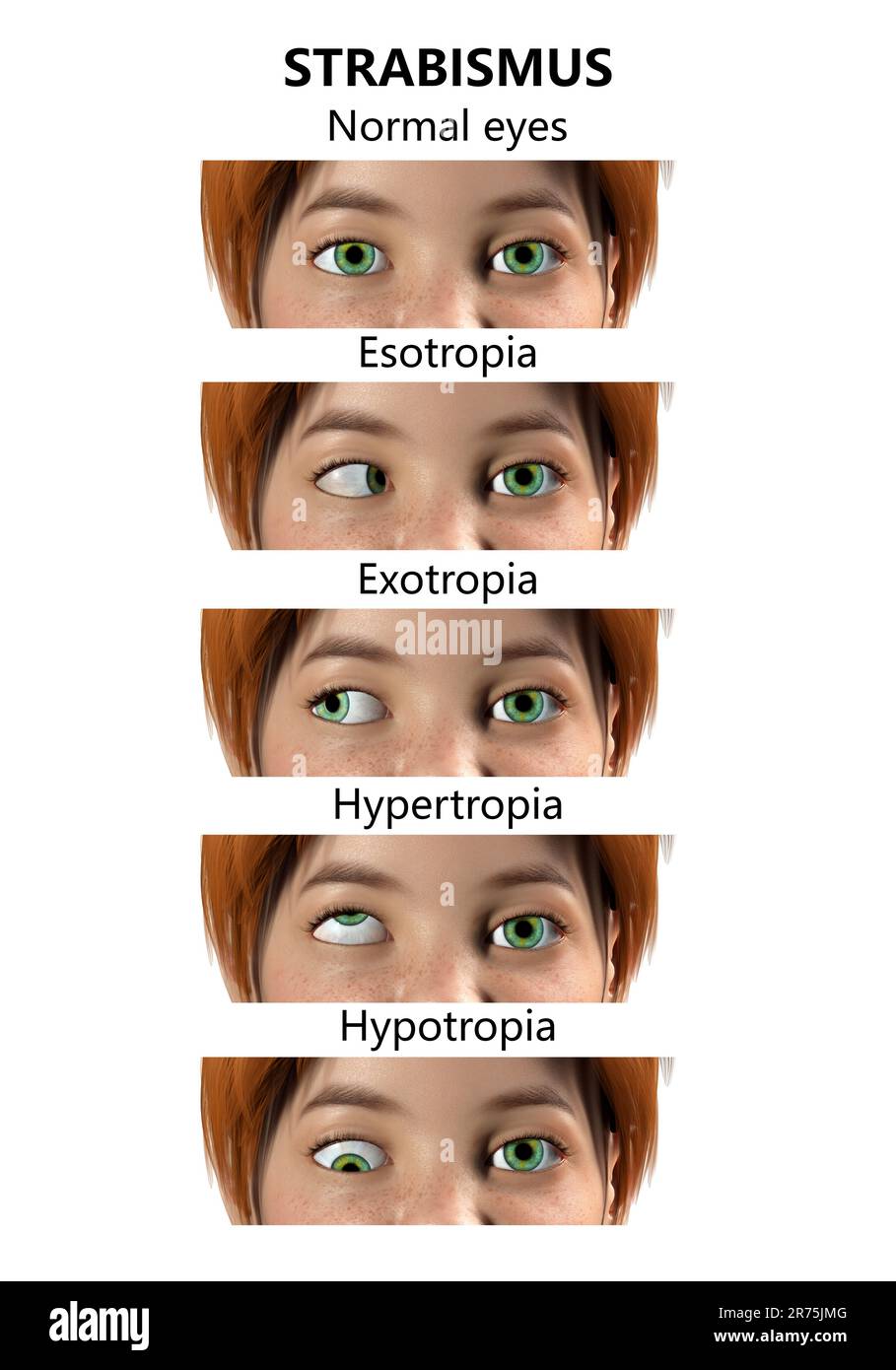 Childhood strabismus types, computer illustration Stock Photo - Alamy Childhood strabismus types, computer illustration Stock Photo - Alamy