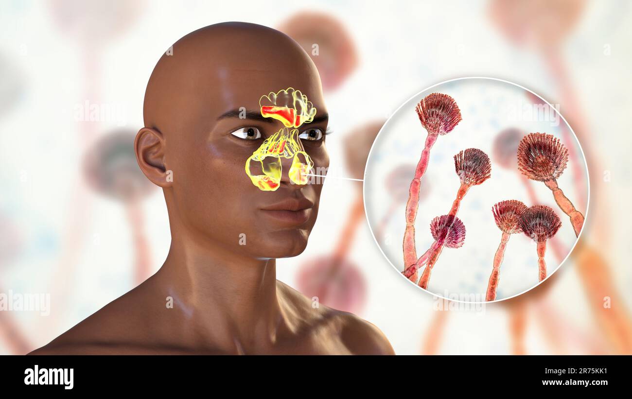 Fungal sinusitis, computer illustration. The sinuses are membrane-lined ...