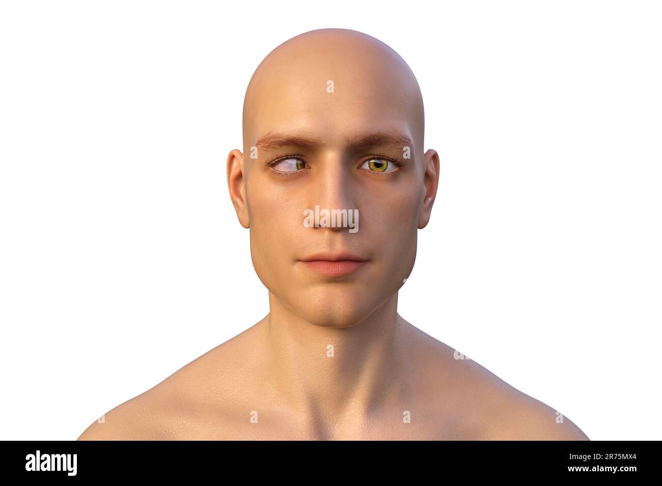 Illustration of esotropia, a form of strabismus where one or both eyes ...