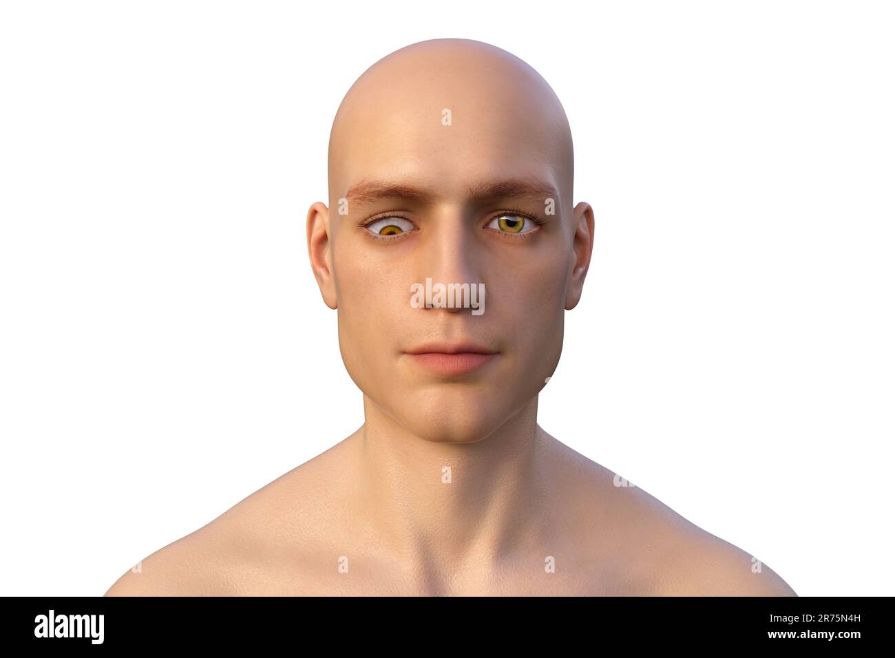 Illustration of hypotropia, a form of vertical strabismus where there ...