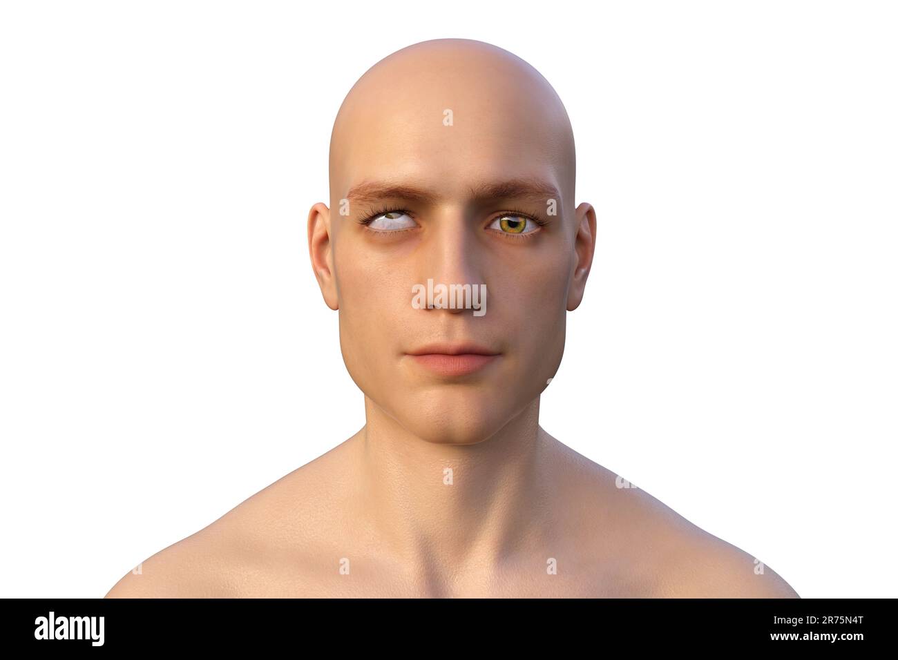 Illustration of hypertropia, a form of vertical strabismus where there ...