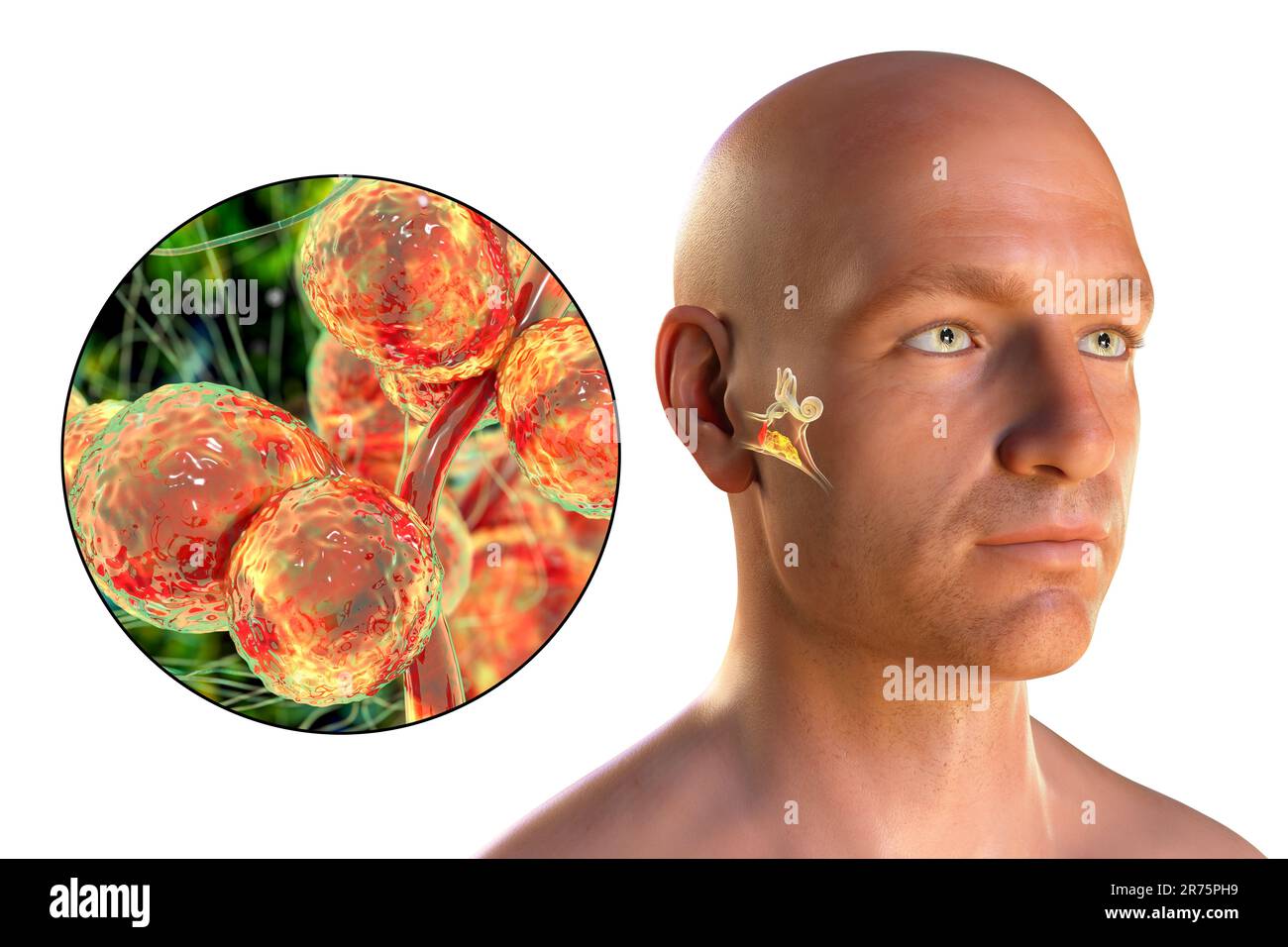 Chronic Fungal Otitis Media Ear Infection Computer Illustration Showing Inflammation Of The