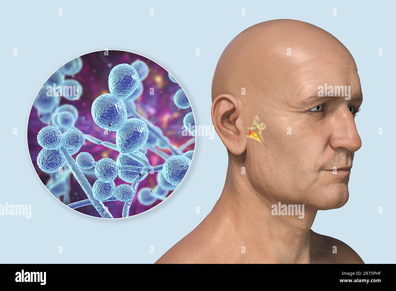 Chronic fungal otitis media ear infection. Computer illustration ...