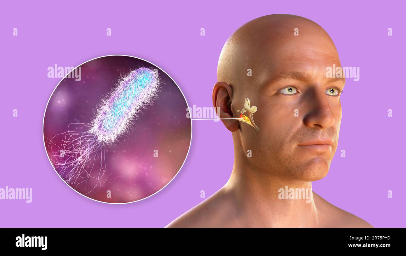 Pseudomonas aeruginosa bacterium as a cause of otitis media. Computer ...