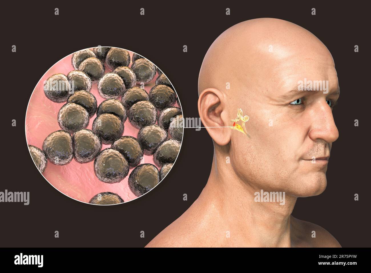 Otitis media ear infection caused by Streptococcus pneumoniae bacteria ...