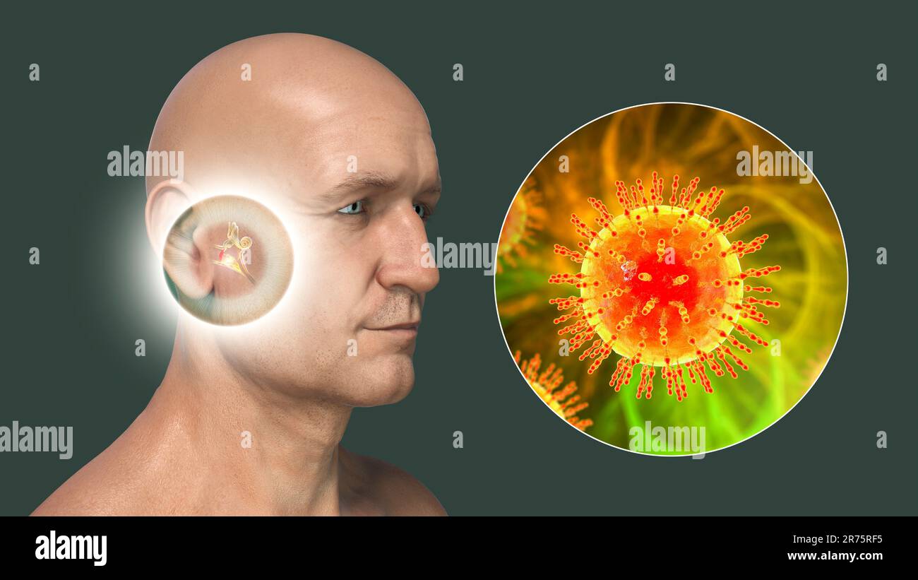 Viral otitis media, a group of inflammatory diseases of the middle ear ...