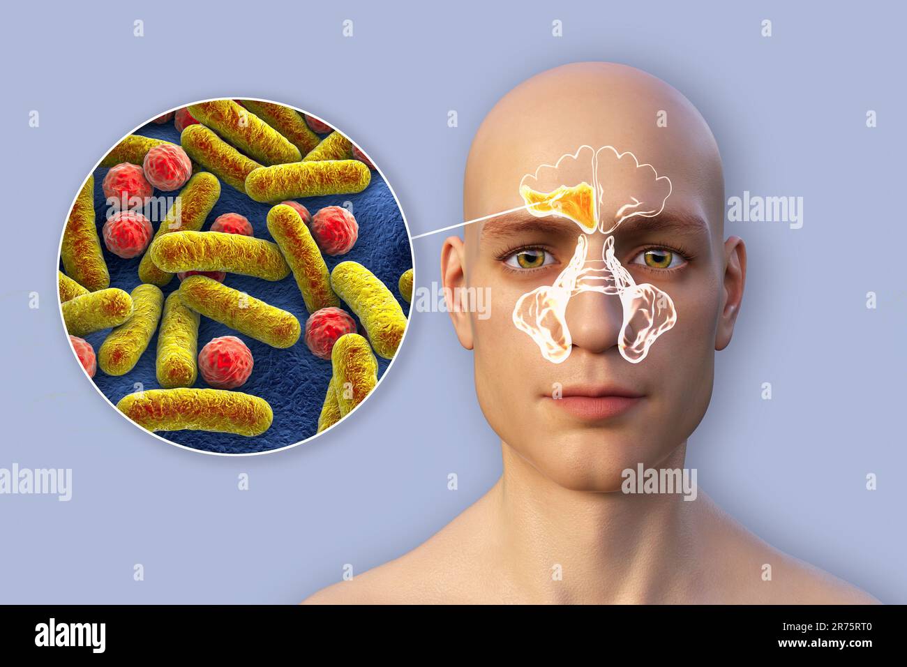 Sinusitis Inflammation Of Paranasal Cavities Computer Illustration Showing Purulent