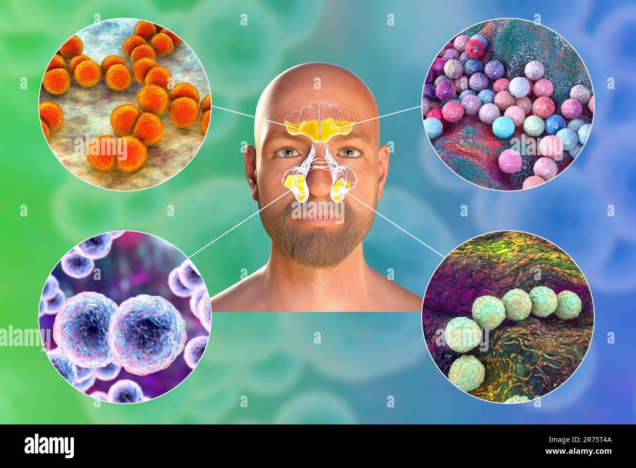 Rhinosinusitis in a man and bacteria that cause sinusitis ...