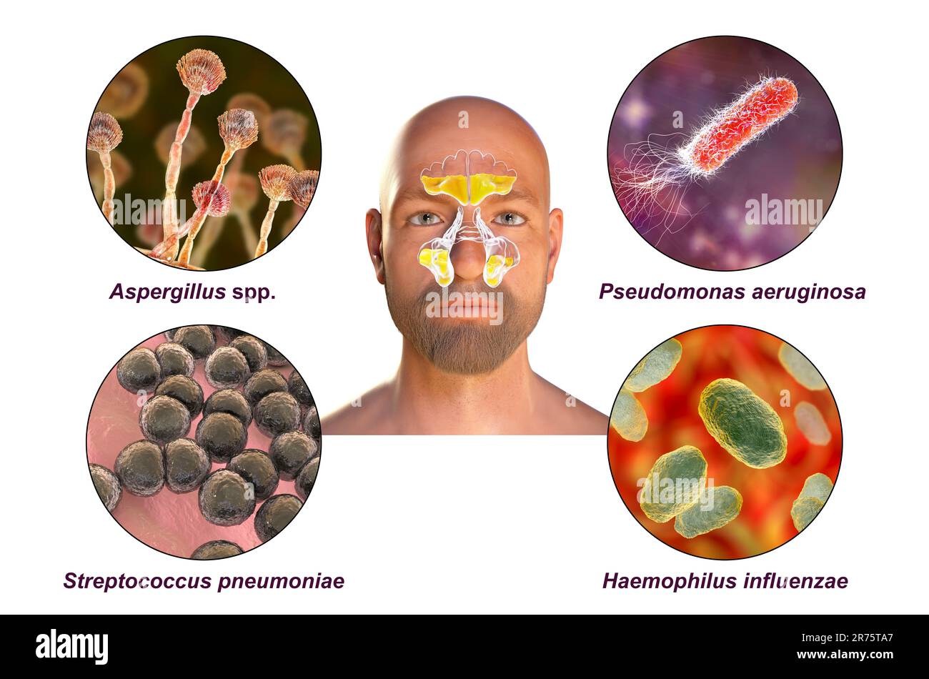 Rhinosinusitis And Microorganisms That Cause Sinusitis Fungi Aspergillus Bacteria Pseudomonas