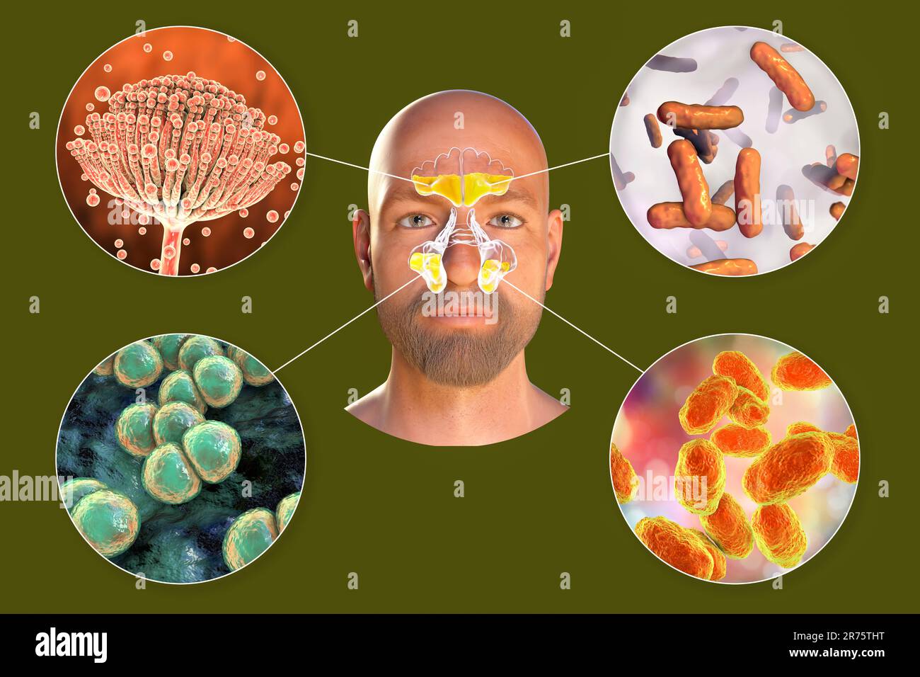 Rhinosinusitis And Microorganisms That Cause Sinusitis Fungi