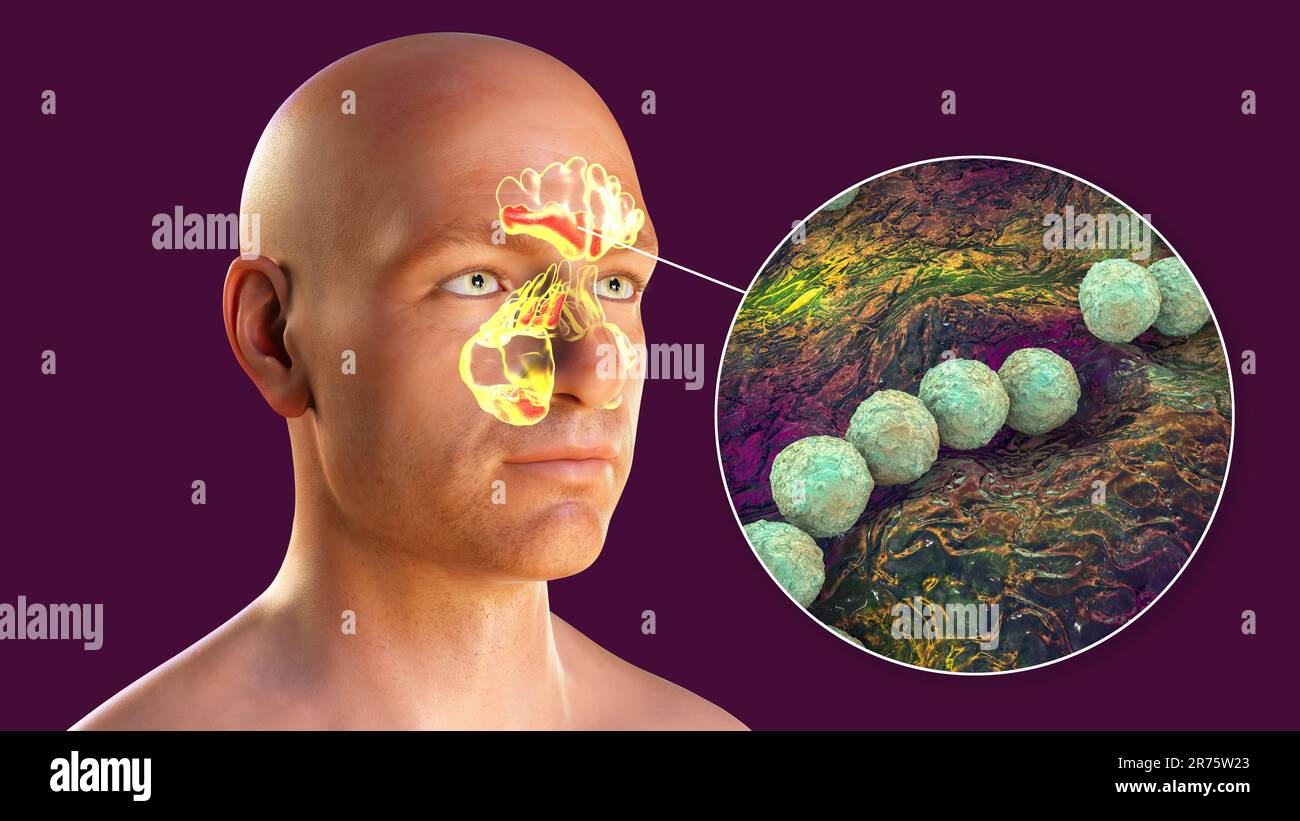 Streptococcus pyogenes bacteria as a cause of sinusitis. Computer ...