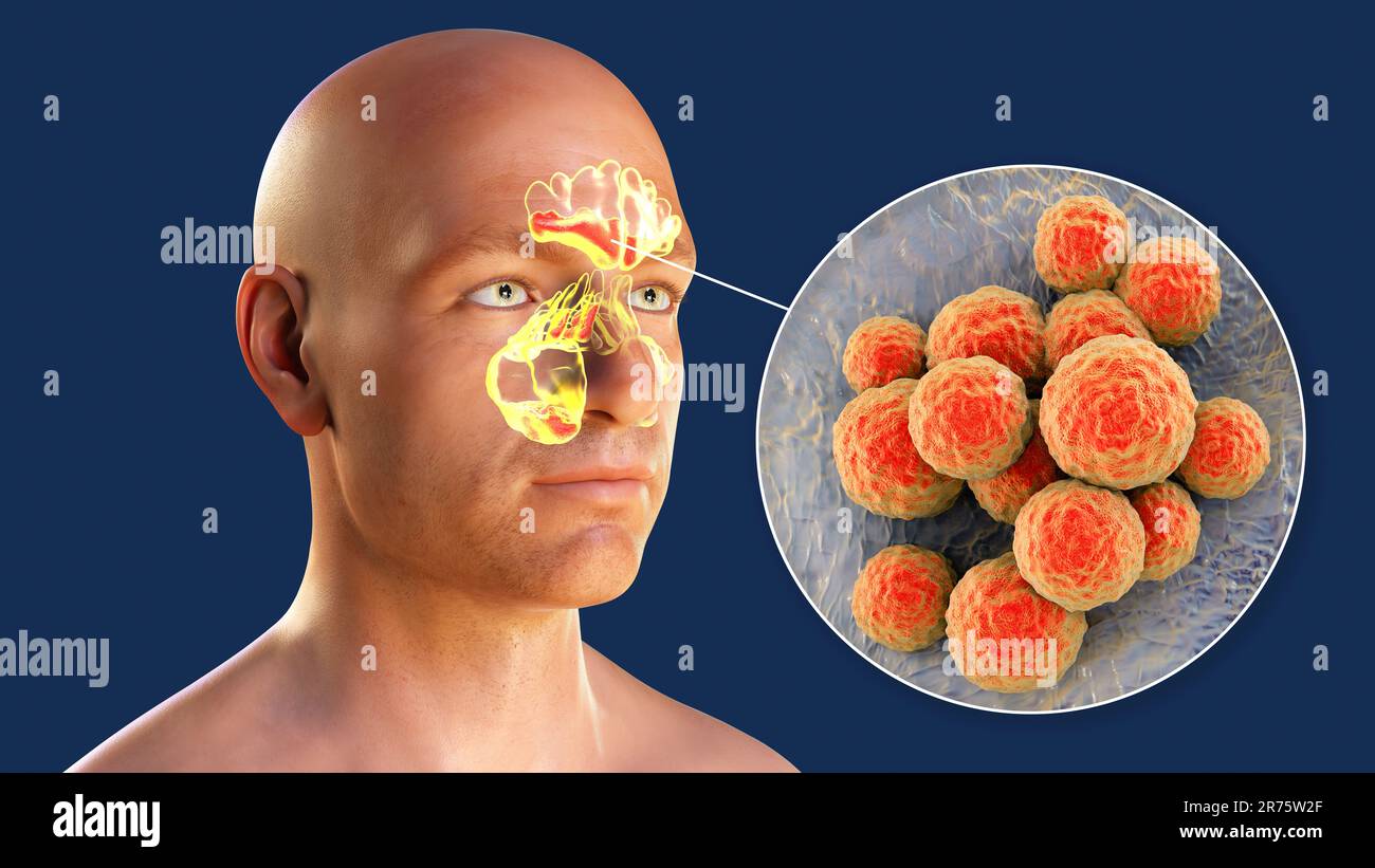 Staphylococcus aureus bacteria as a cause of sinusitis. Computer ...