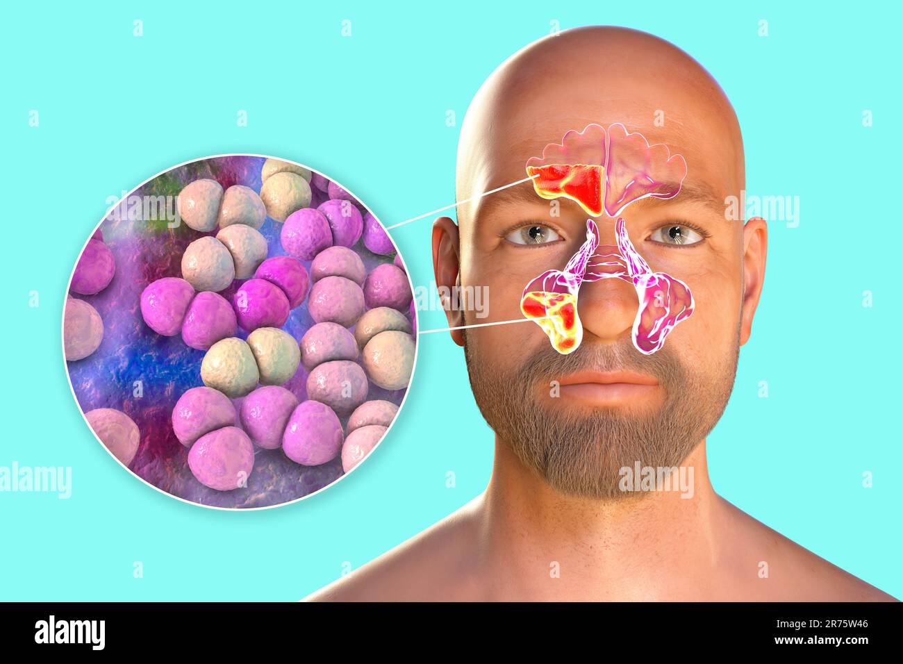 Streptococcus Pneumoniae Bacteria As A Cause Of Sinusitis Computer