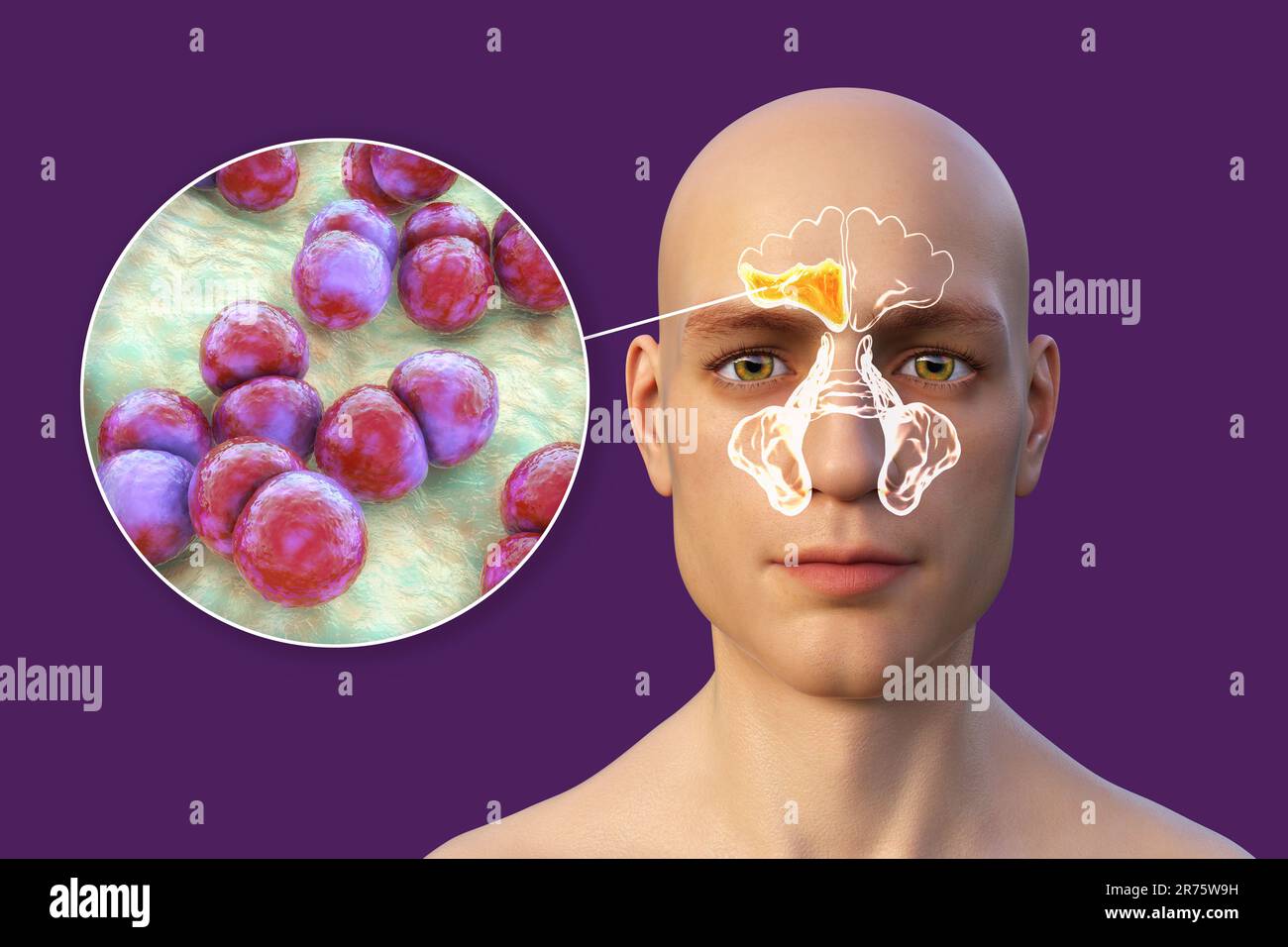 What Is Sinusitis And How Is It Caused Pharmacy Magazine