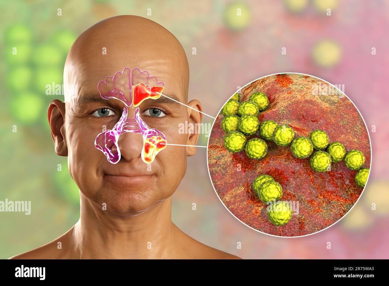 Streptococcus pyogenes bacteria as a cause of sinusitis. Comouter ...