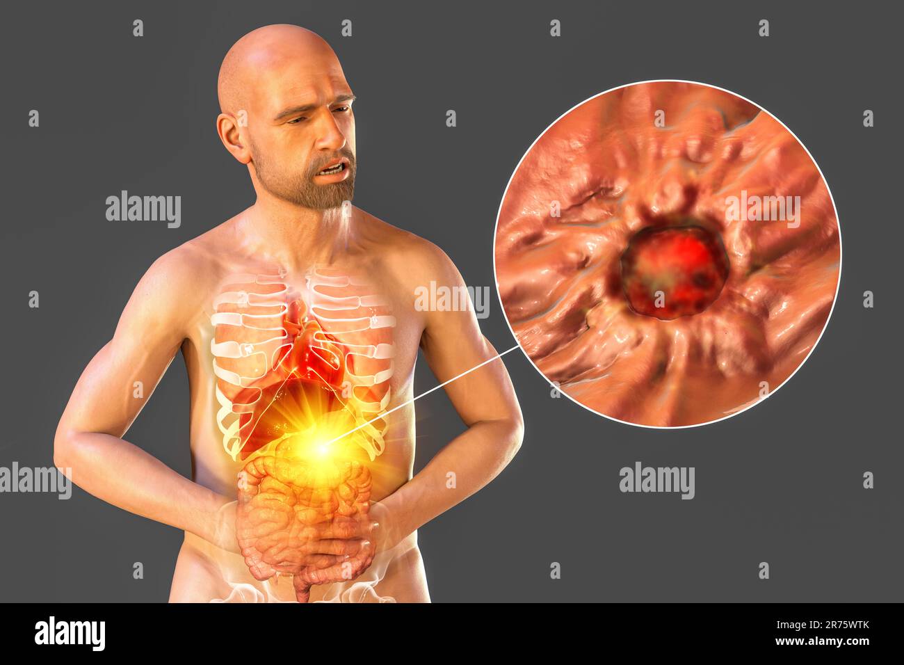 Pain in stomach, conceptual computer illustration. A man suffering from ...