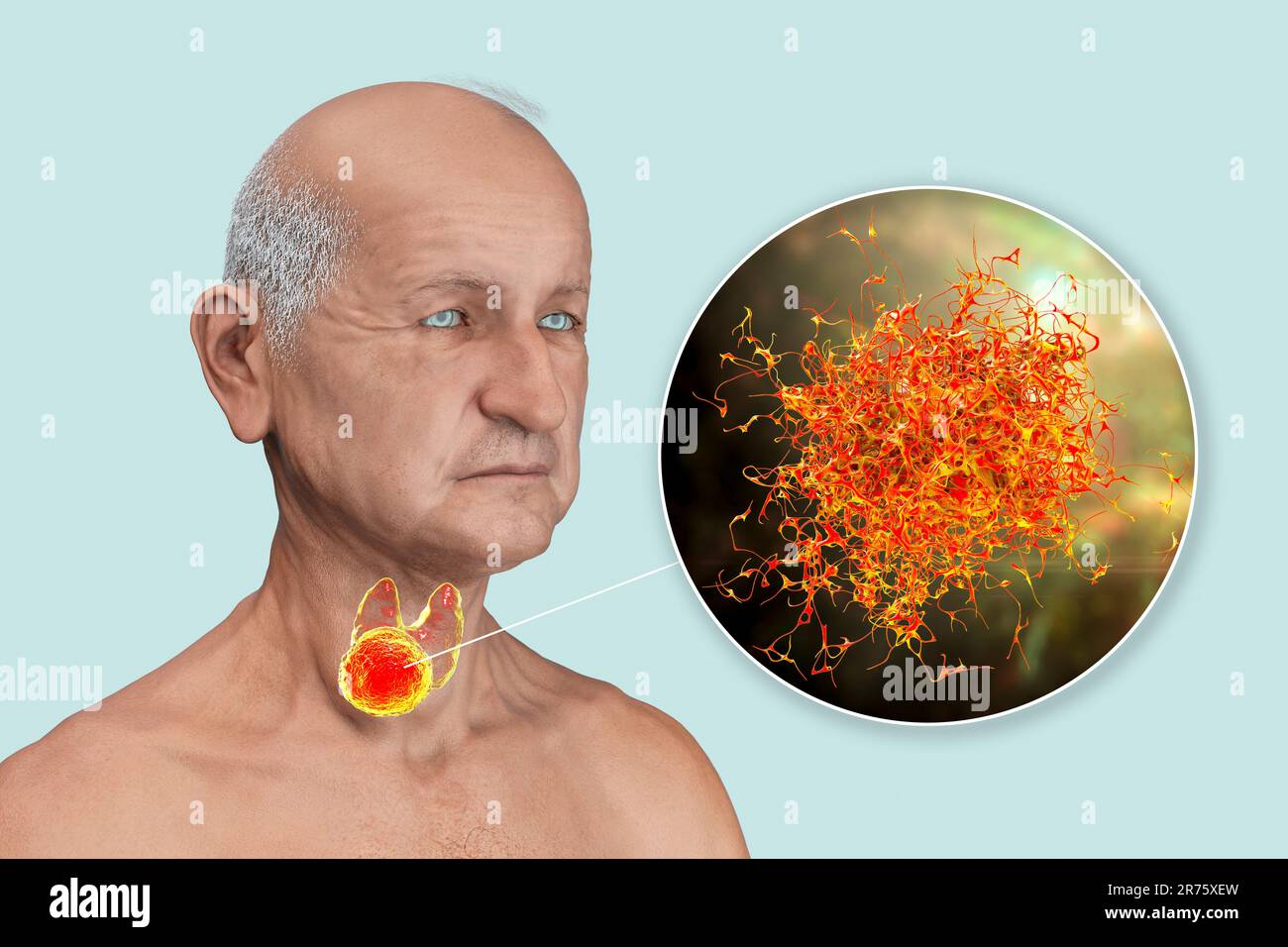 Thyroid gland cancer with closeup view of cancer cells, computer ...