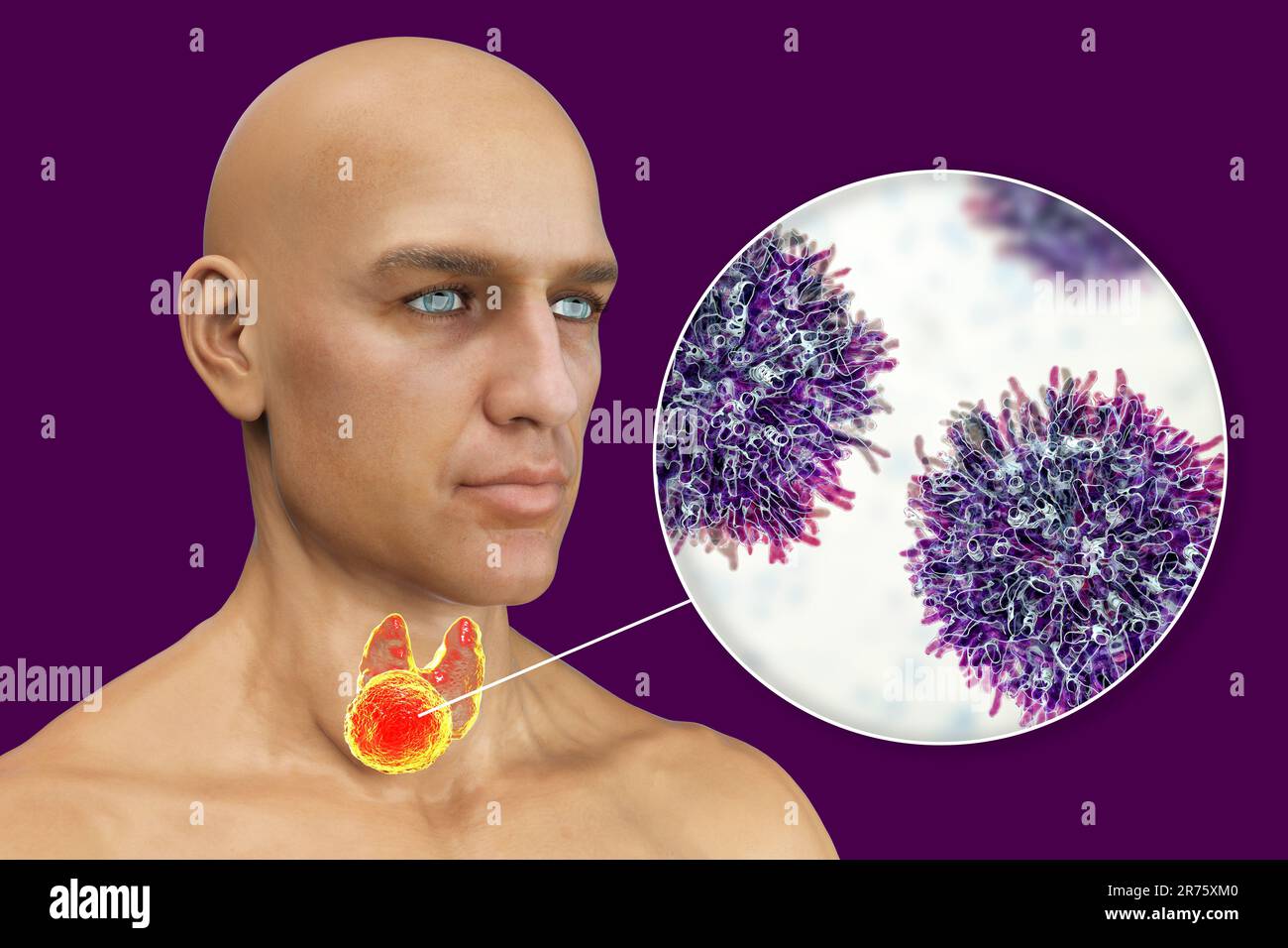 Thyroid gland cancer with closeup view of cancer cells, computer ...