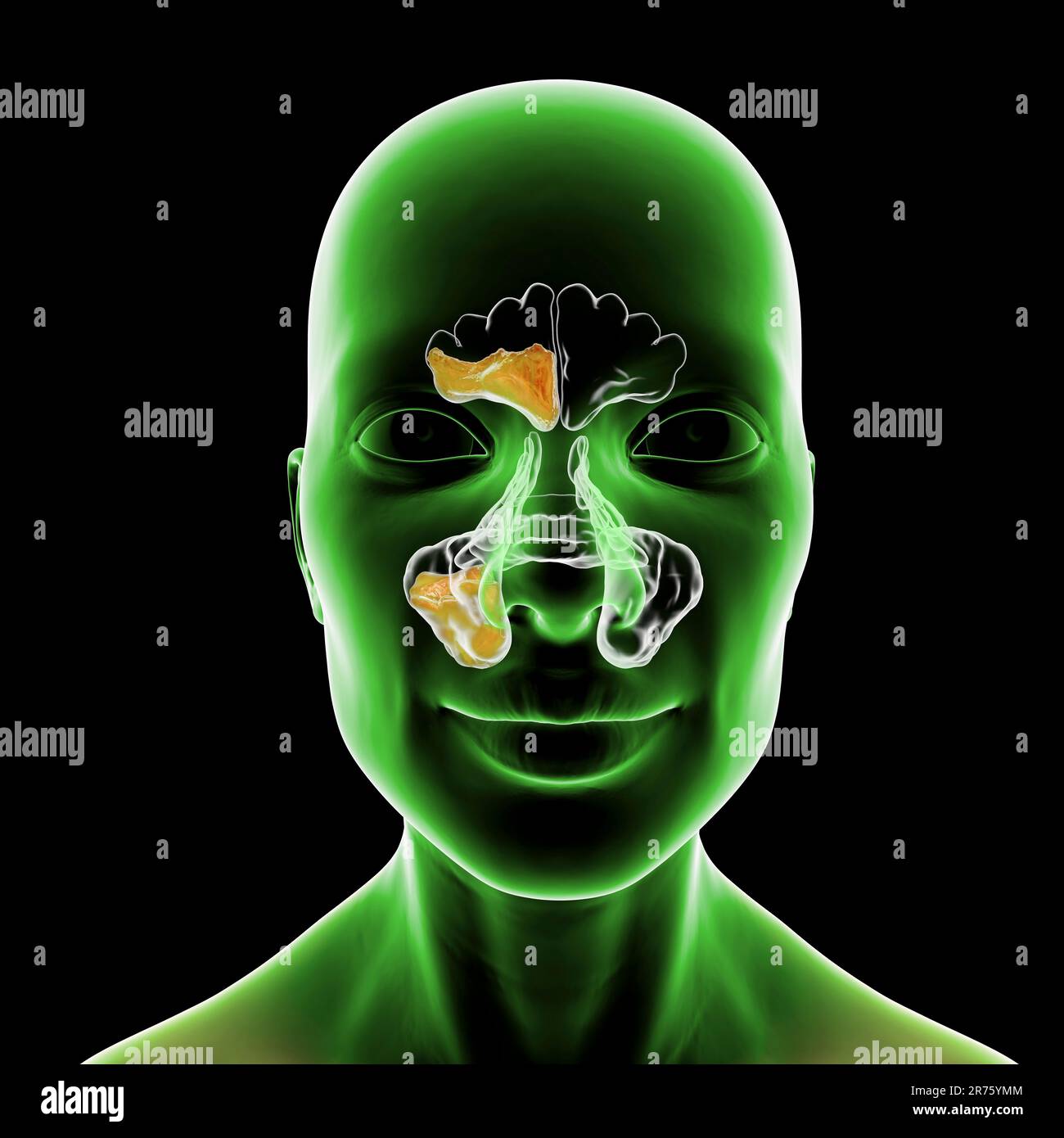 Sinusitis, computer illustration. The sinuses are membrane-lined air ...