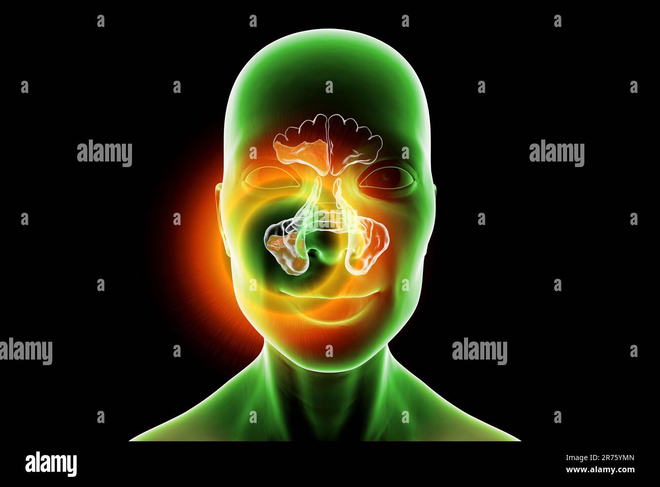 Sinusitis, computer illustration. The sinuses are membrane-lined air ...