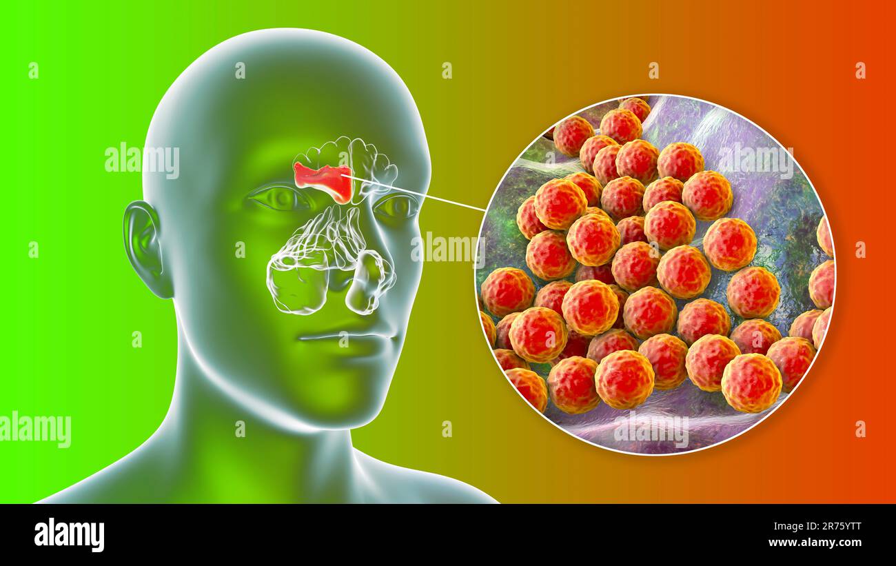 Bacterial sinusitis, computer illustration. The sinuses are membrane ...