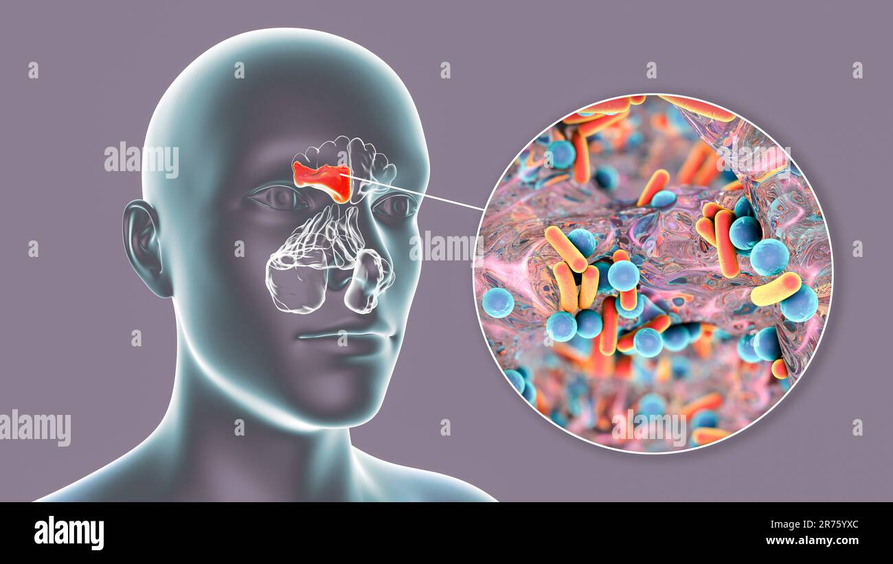 Bacterial sinusitis, computer illustration. The sinuses are membrane ...