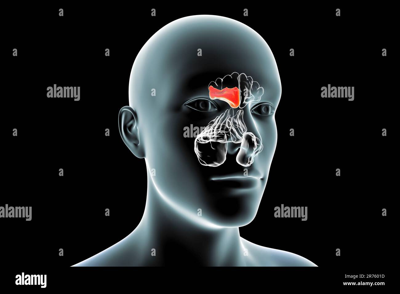 Sinusitis, computer illustration. The sinuses are membrane-lined air ...