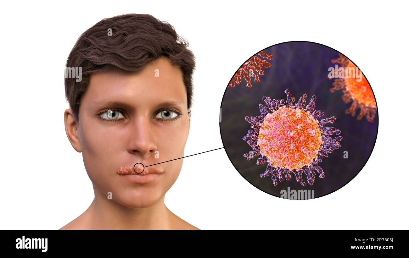 Cold sore on the lip of a man and closeup view of herpes simplex ...