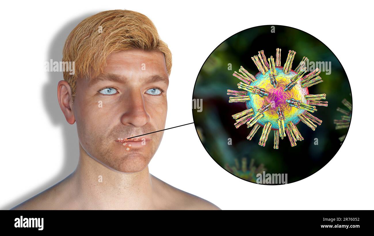 Cold sore on the lip of a man and closeup view of herpes simplex ...