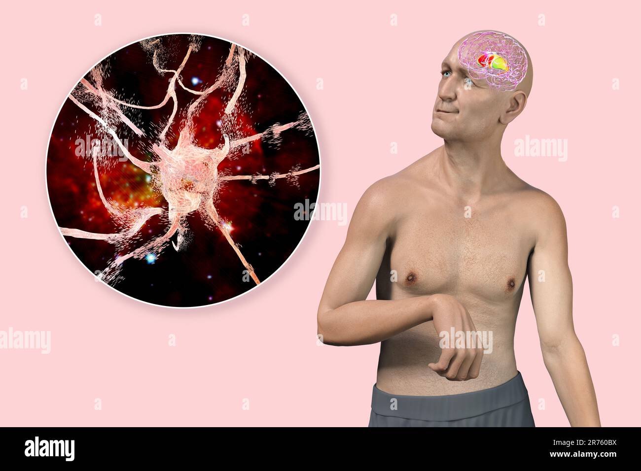 A person with chorea disease and close-up view of neuronal degradation ...