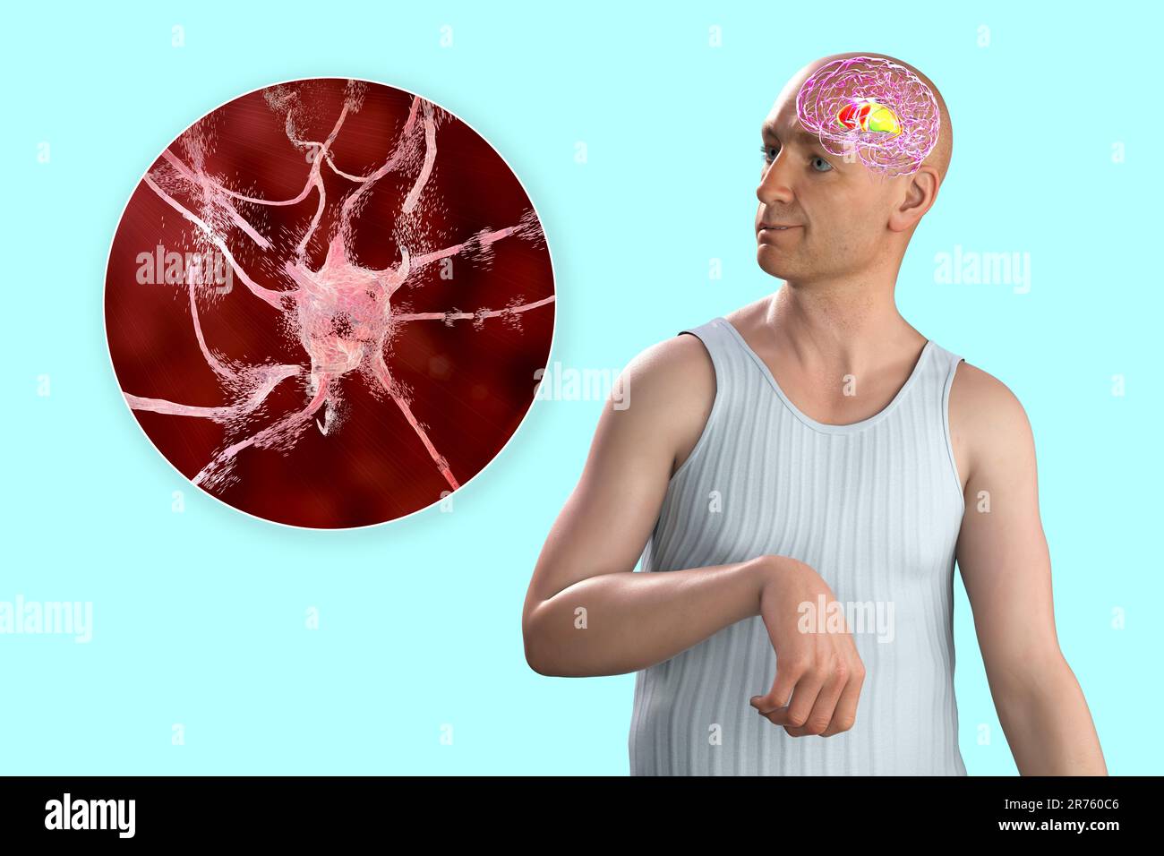 A person with chorea disease and close-up view of neuronal degradation ...