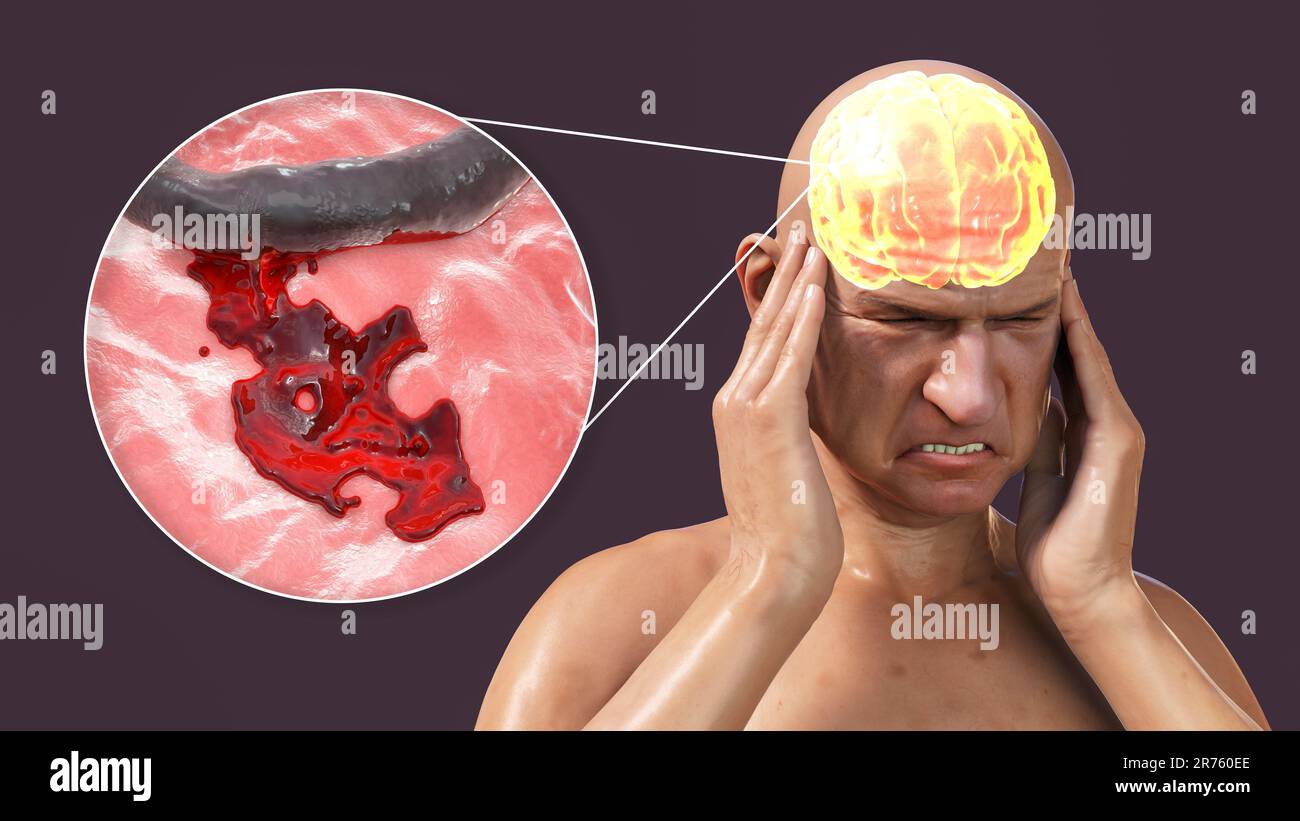 Haemorrhagic stroke, computer illustration showing a person with ...
