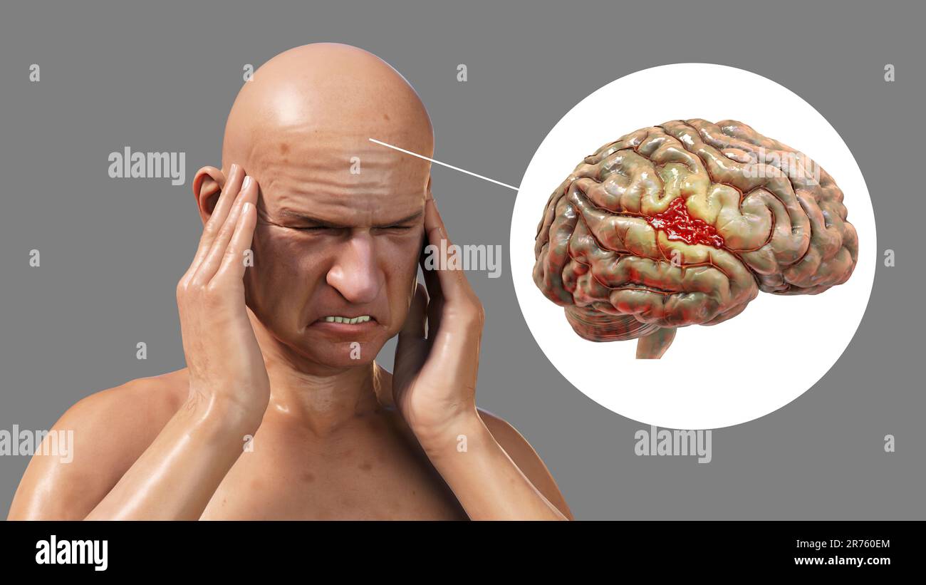 Ruptured blood vessel hi-res stock photography and images - Alamy