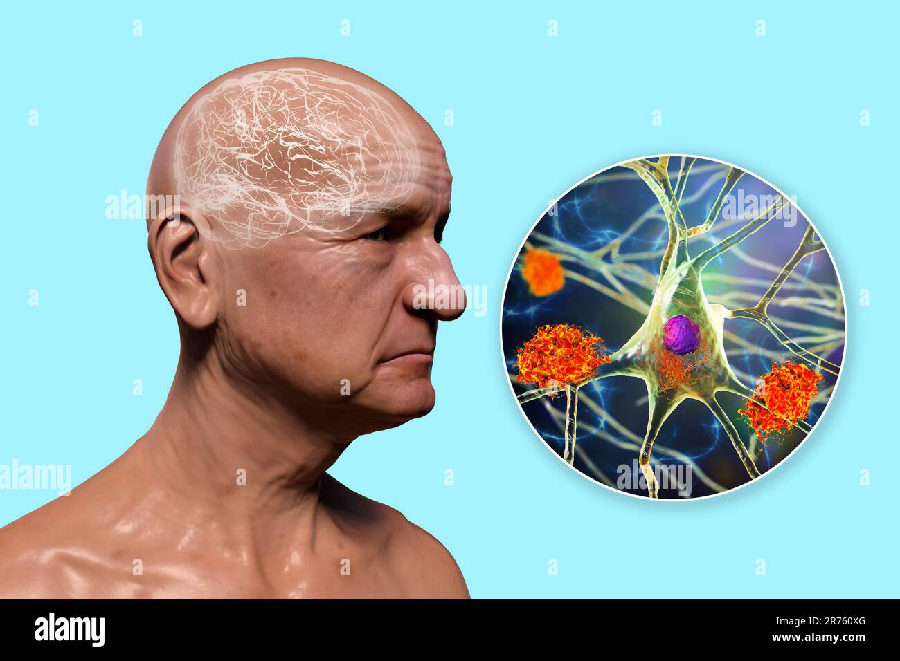 Dementia, conceptual computer illustration showing an elderly person ...