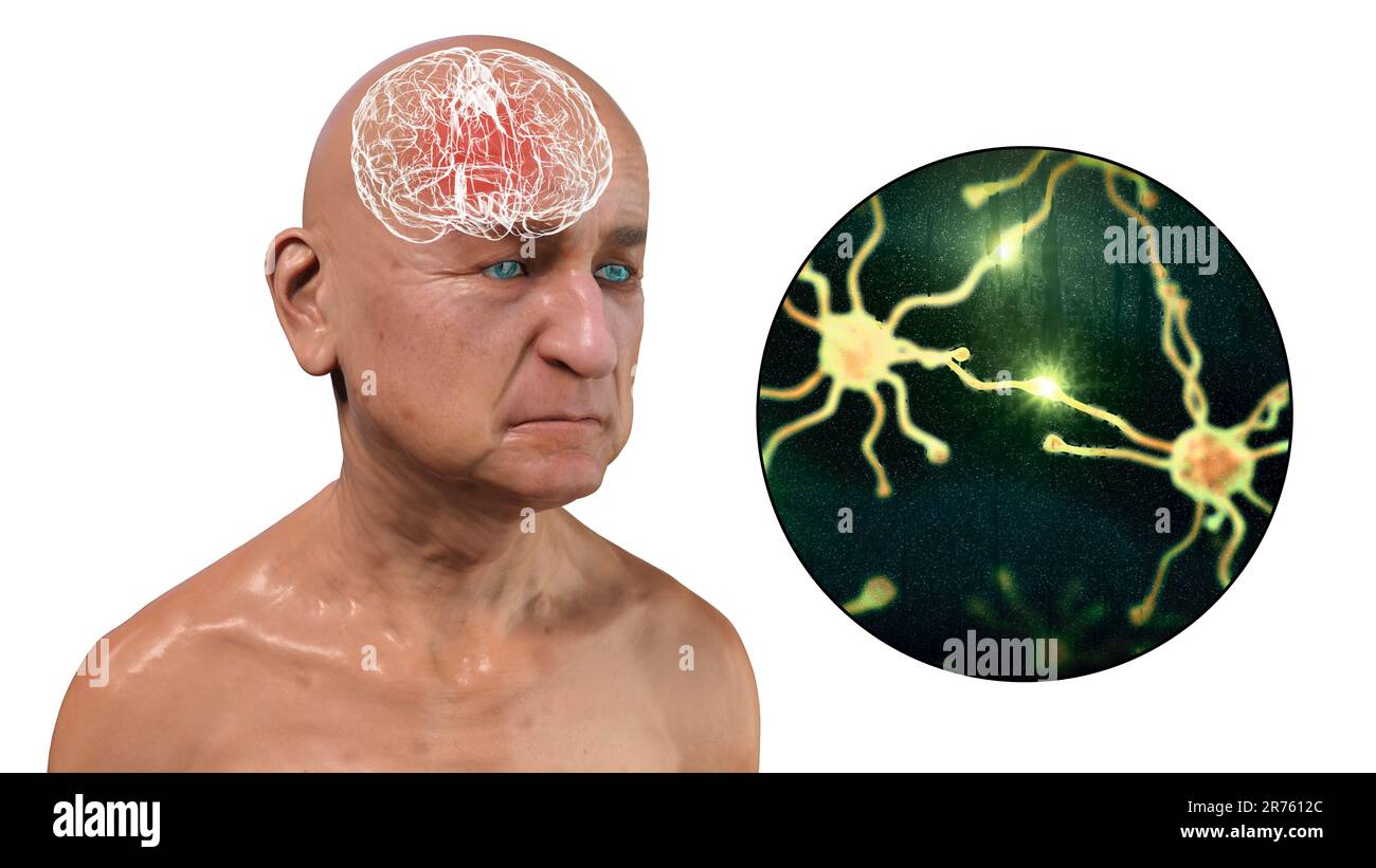 Dementia, conceptual computer illustration showing an elderly person ...
