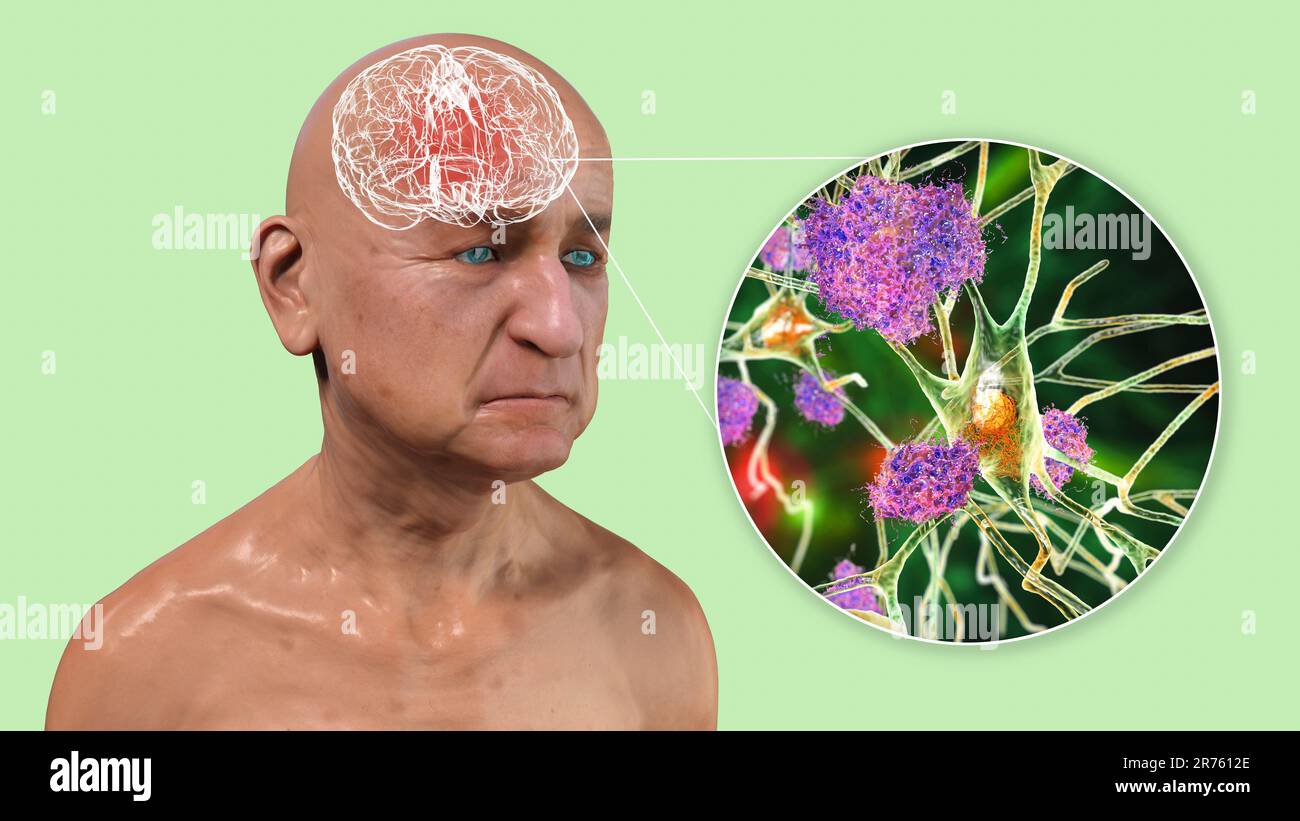 Alzheimer's disease, conceptual computer illustration showing an ...