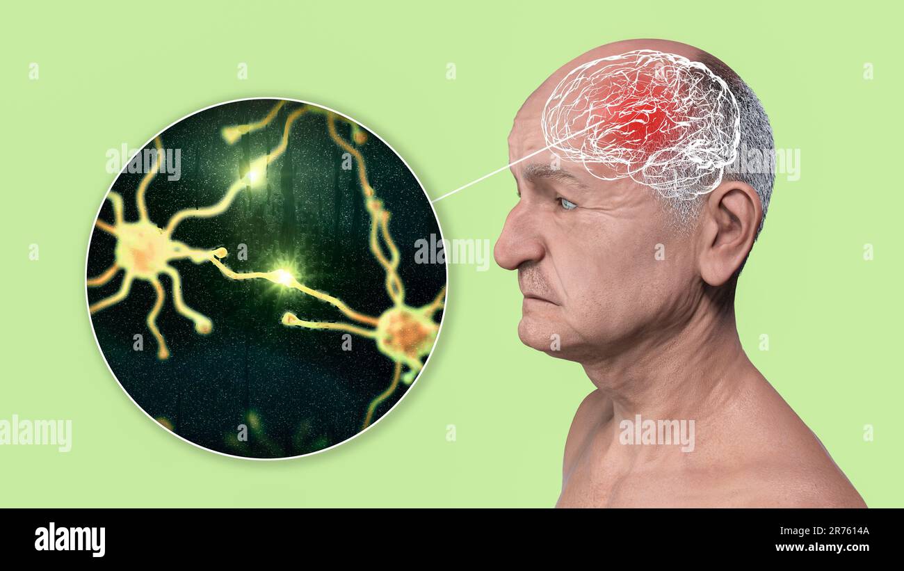 Dementia, conceptual computer illustration showing an elderly person ...