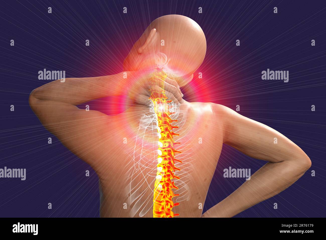 Human neck pain, computer artwork Stock Photo - Alamy