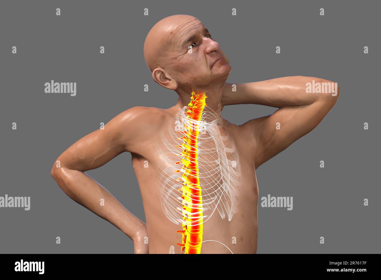 Human neck pain, computer artwork Stock Photo - Alamy