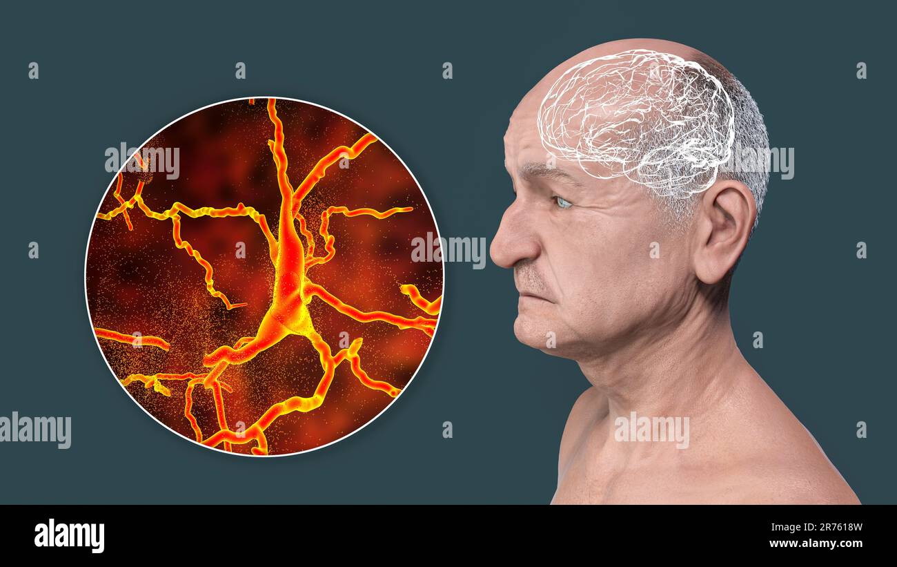 Dementia, conceptual computer illustration showing an elderly person ...