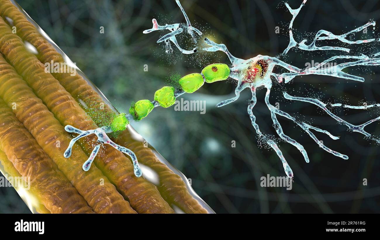Degradation of motor neurons, conceptual computer illustration. Motor ...