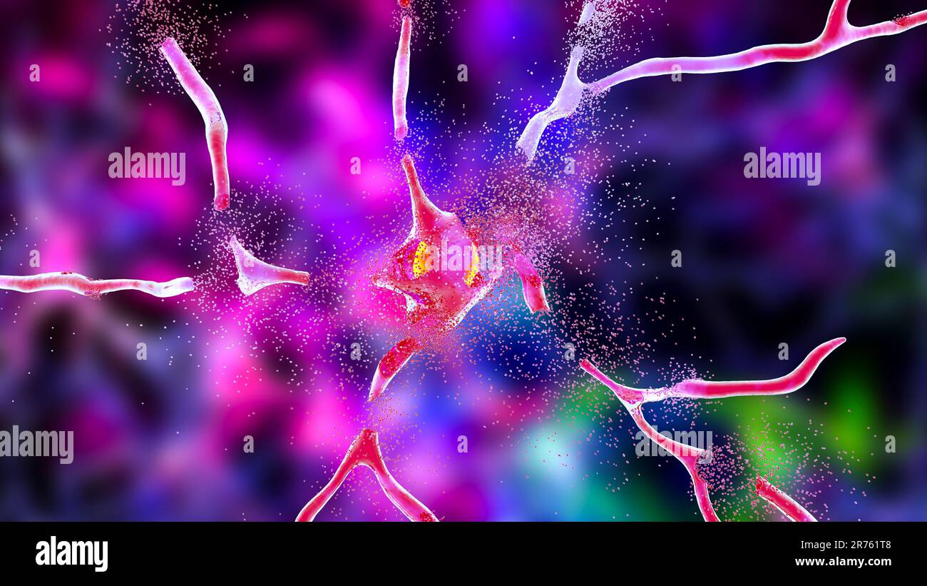Destruction of neurons of Dorsal striatum, conceptual computer ...