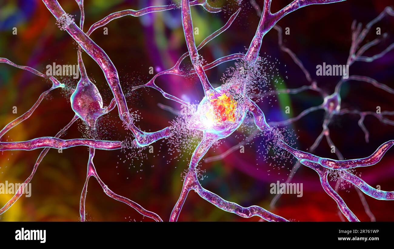 Destruction of neurons of Dorsal striatum, conceptual computer ...