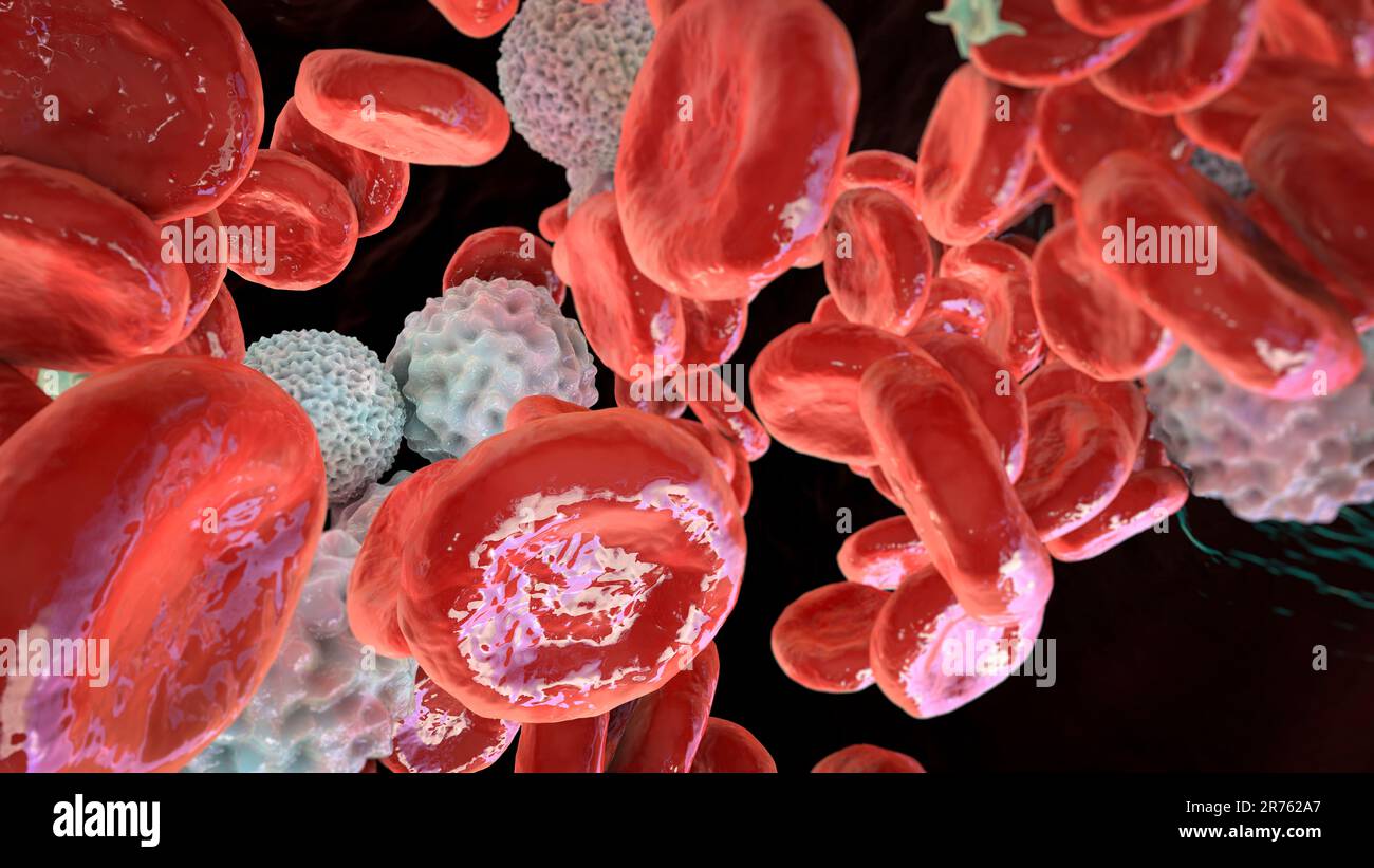 Polycythemia vera, computer illustration. Polycythemia vera is a rare slow-growing blood cancer ...