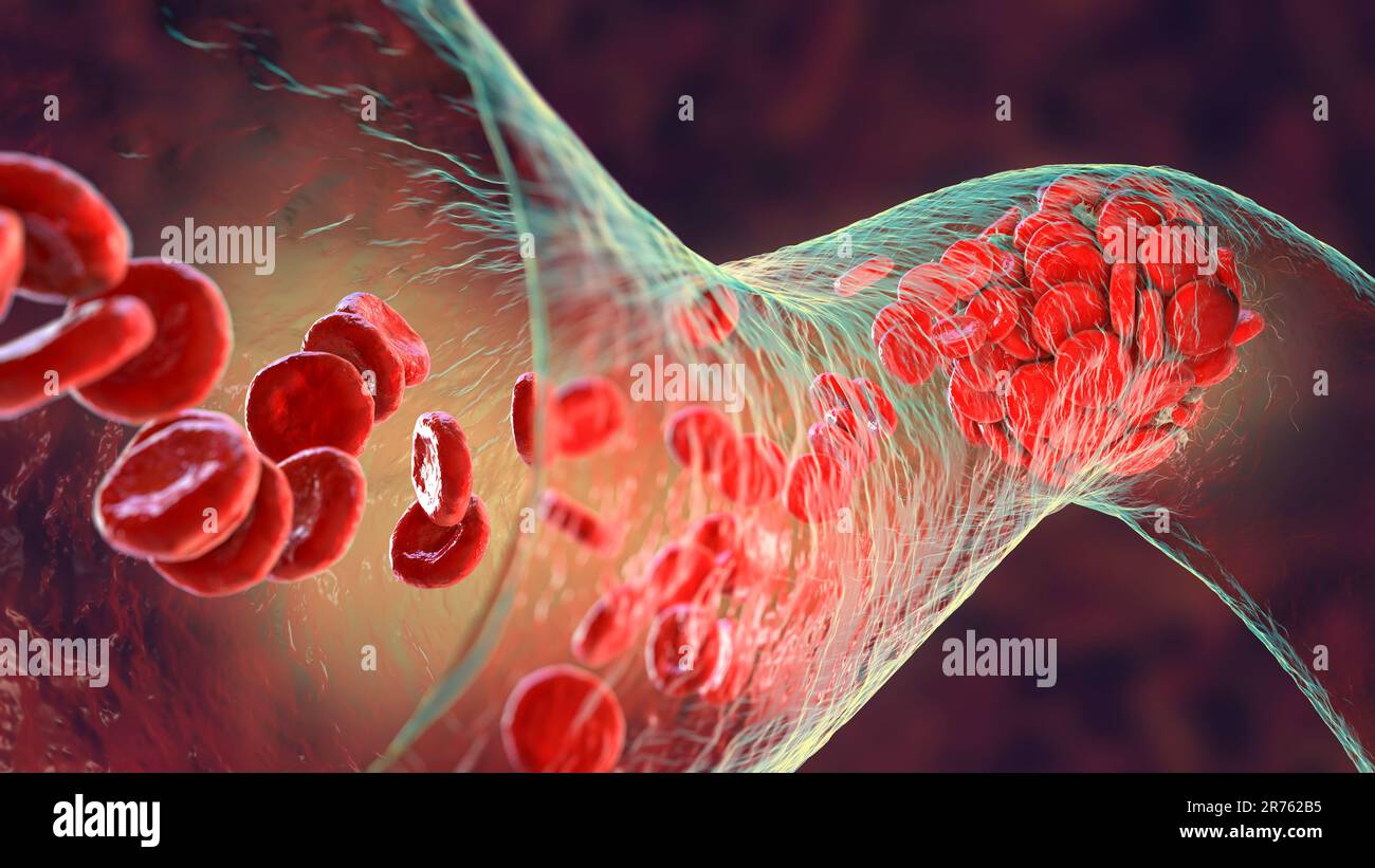 Blood clot, computer artwork Stock Photo - Alamy