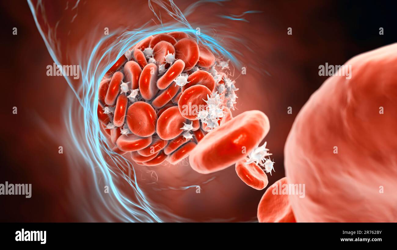 Blood clot, computer artwork Stock Photo - Alamy