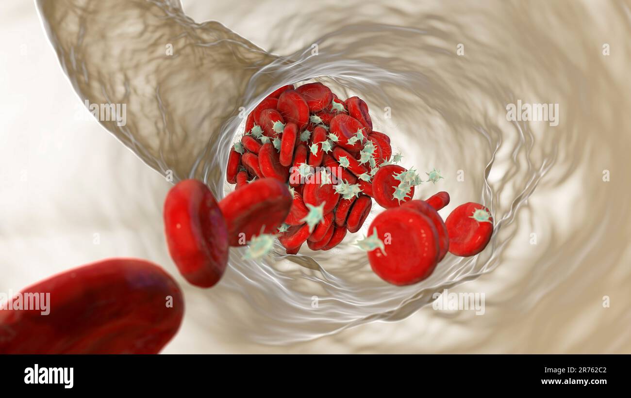 Blood clot, computer artwork Stock Photo - Alamy