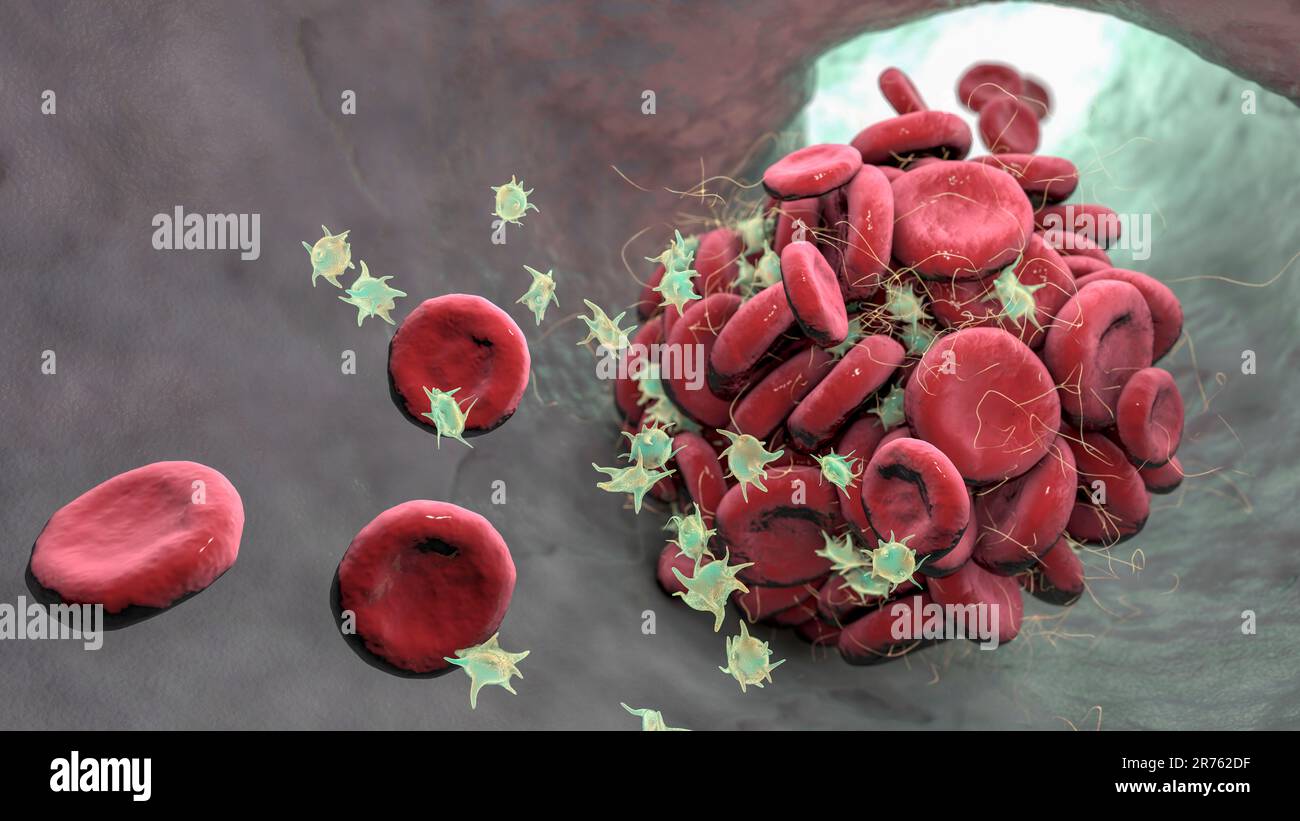 Blood clot, computer artwork Stock Photo - Alamy