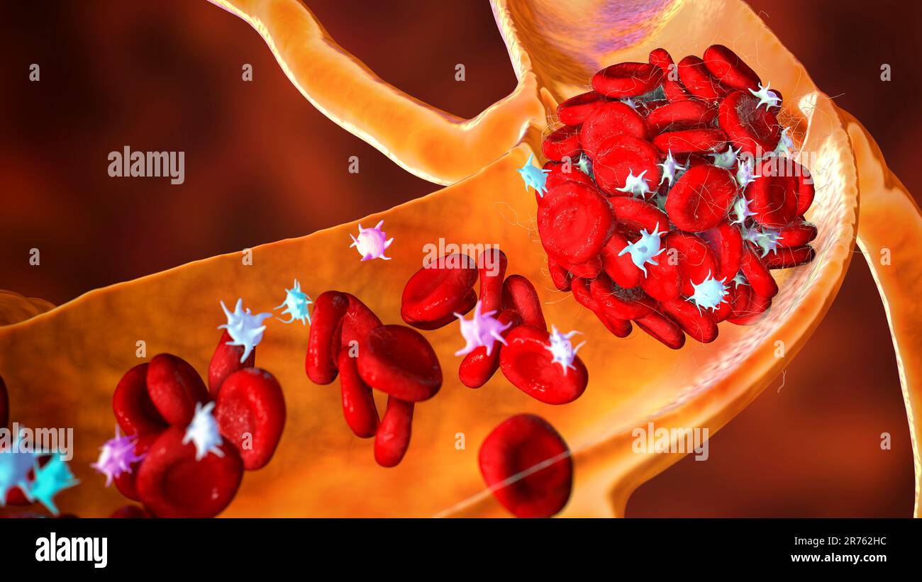 Blood clot, computer artwork Stock Photo - Alamy